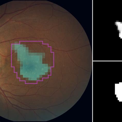 examples of lesion activation maps provided by the a l max models for