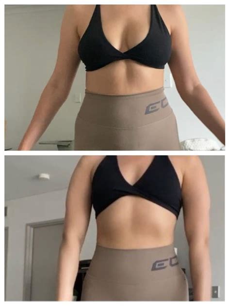 Cellulite On Belly Post Partum Rfitpregnancy