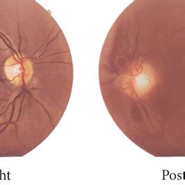 Macular OCT And Color Photograph Showing Normal Findings Download Scientific Diagram