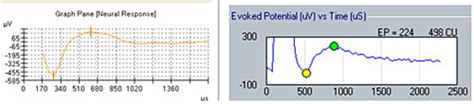 Fundamentals Of Clinical ECAP Measures In Cochlear Implants Part Measurement Techniques And
