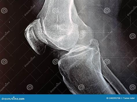Plain X Ray On Knee Joint Showing Joint Space Narrowing And Subchondral Sclerosis On Medial
