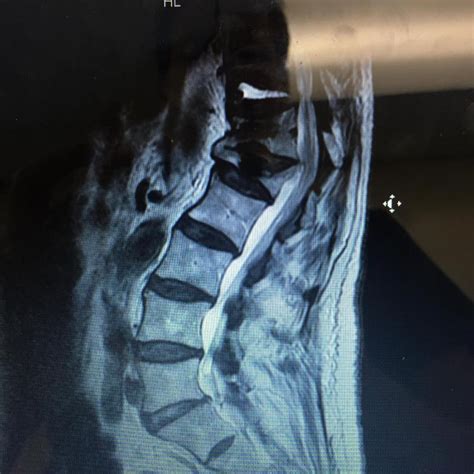 Dr Tim Davis On Linkedin Acute T11 Inferior Endplate Compression Fracture Kyphoplasty…
