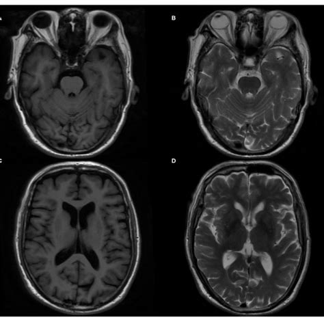 Brain Magnetic Resonance Imaging Mri In The Patient Ac