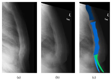 Protruding Xiphoid Process Surgery