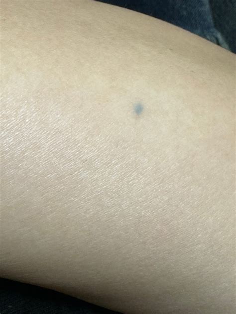 팔에 파란색 점 지식in