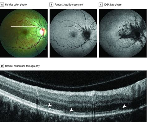 Acute Retinopathy In Pseudoxanthoma Elasticum Pmc
