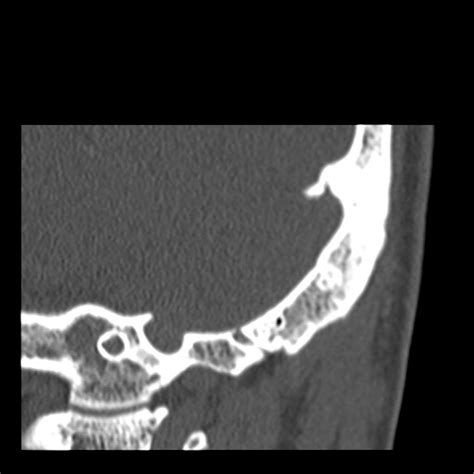 Normal Temporal Bone Ct With Annotated Images Radiopaedia 84293 99584