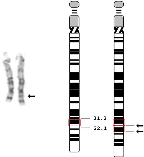 Figure 2 From An Interstitial Duplication Of Chromosome 13q313q321