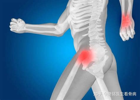 强直患者髋关节一旦受累，很有可能急速发展并致残？ 知乎