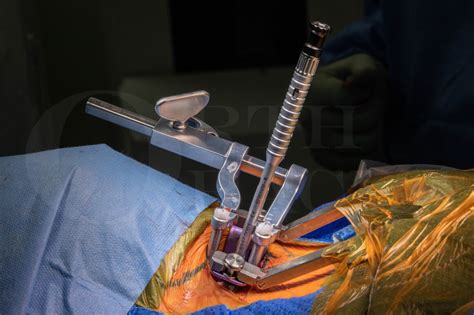 Anterior Cervical Decompression And Fusion Using Globus Coalition Mis Cage Surgical Technique
