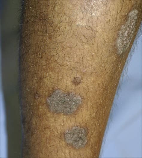 A Novel Visual Clue For The Diagnosis Of Hypertrophic Lichen Planus