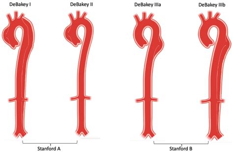 Valve Sparing Aortic Root Surgeries Figure Reproduced From Buratto E Download Scientific