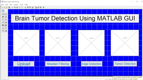 Brain Tumor Detection Using Matlab Gui
