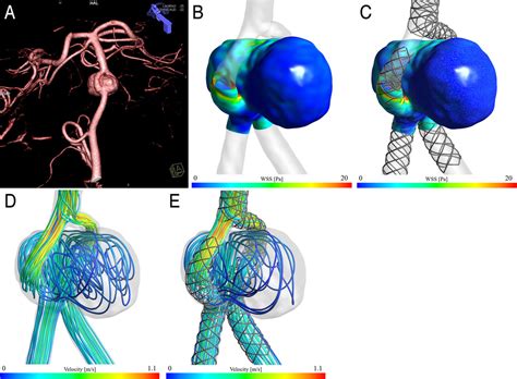Computational Fluid Dynamics As A Risk Assessment Tool For Aneurysm Rupture In Neurosurgical