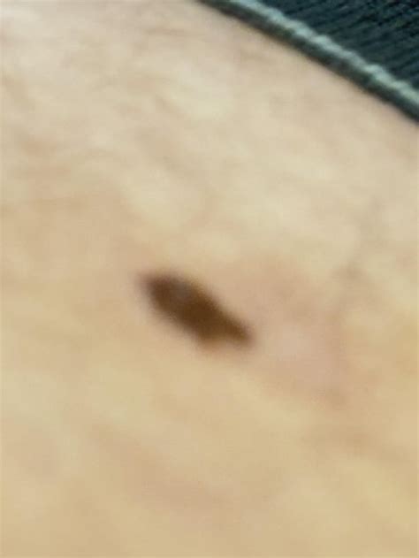 Does Anyone Know What Kinda Bug This Is R Scabies