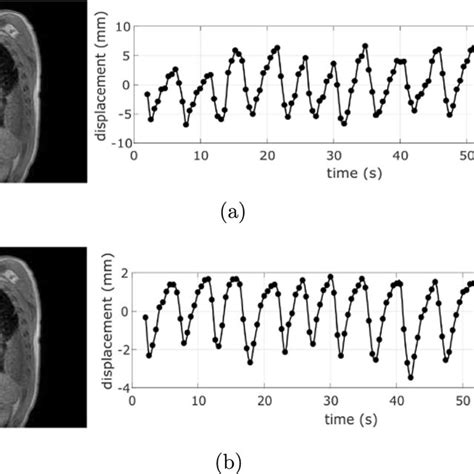 Example Of Interpolated Local Surrogate Signals For The Sagittal