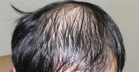 脫髮攻略 2大常見男性脫髮問題你知道嗎？ Hairhealth