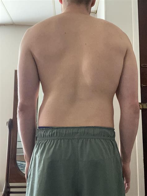 29m 56°~ Curve Thoracic 30°~ Compensatory Lumbar Curve R Scoliosis