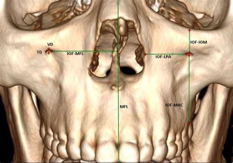 Assessment Of Infraorbital Foramen Position Using Computed Tomography