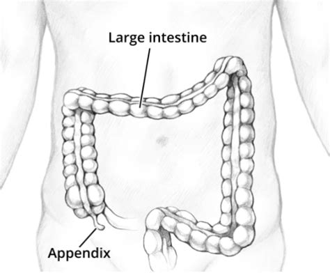 Appendicits