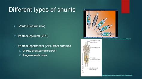 Hydrocephalus Shunts By Alex Gray Bme 281 What