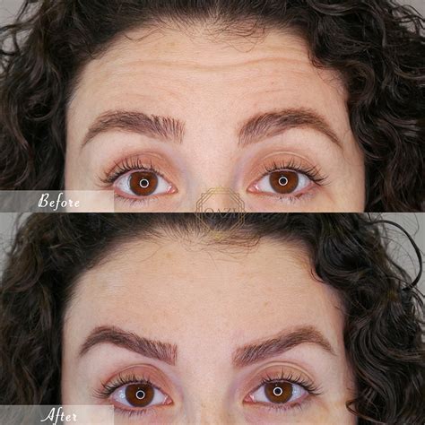 How Many Units Are In A Syringe Of Botox