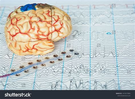 Human Brain Model Subdural Electrode RecordingẢnh Có Sẵn1415577899 Shutterstock