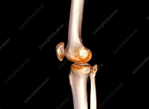 Knee Joint Ct Scan Stock Image F0377170 Science Photo Library