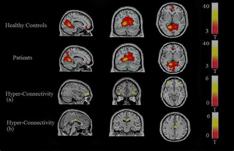 Lingual Gyrus Functional Connectivity Comparison Between Healthy
