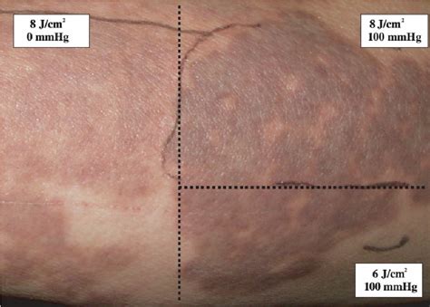 Development Of Purpura In Previously Treated Pws On The Forearm 15