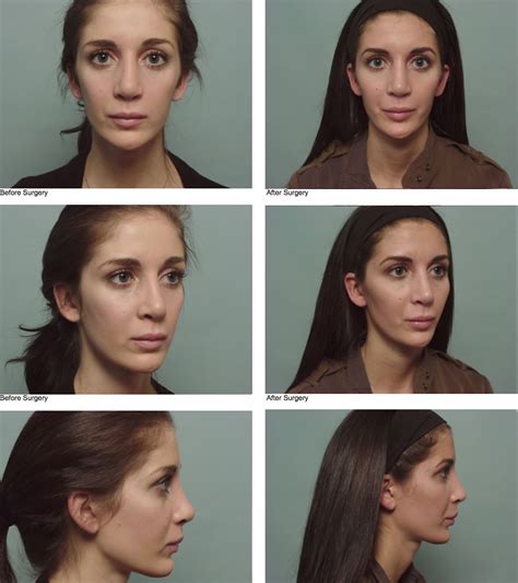 Cheek Implants Allcroft Plastic Surgery