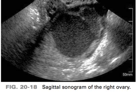 Path Ch 11 Ob Pid And Endometriosis Flashcards Quizlet