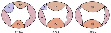 Atrioventricular Canal Defect