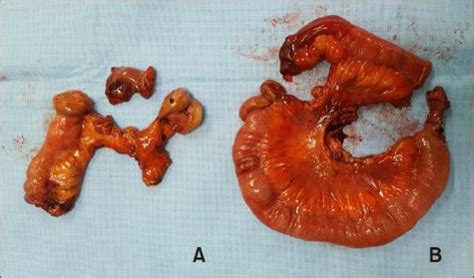 Evisceration After Abdominal Stab Wound Patient Survived Wound