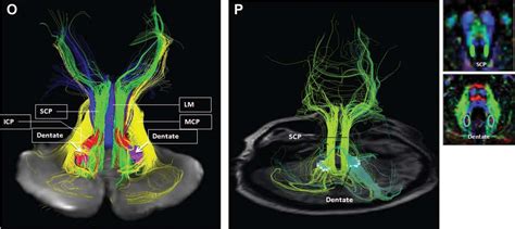 Approaches To Cerebellum Archives Neurosurgery Blog