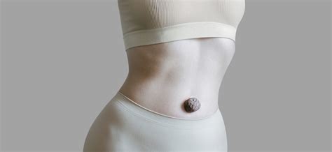 Пупочная грыжа симптомы операция восстановление после удаления грыжи