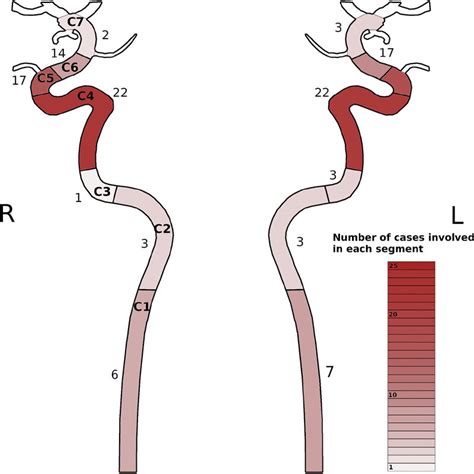 A Schematic Addition Of All Cases Of Ica Internal Carotid Artery Download Scientific Diagram