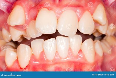 Dental Displacement Stock Image Image Of Gingivitis 33623061