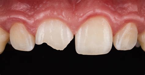 A Guide To Handling Tooth Fractures Southampton Dentist