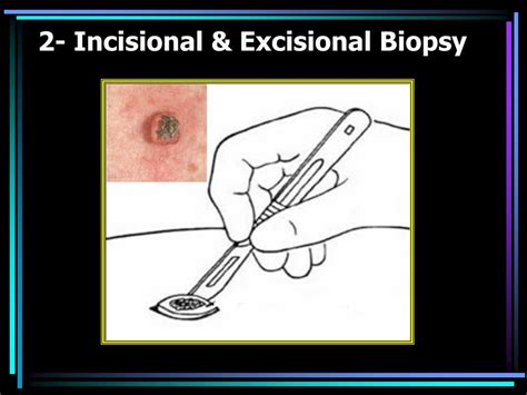 Incisional And Excisional Biopsy Principles Of Biopsy In Oral Surgery