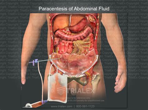 Paracentesis Of Abdominal Fluid Trialquest Inc