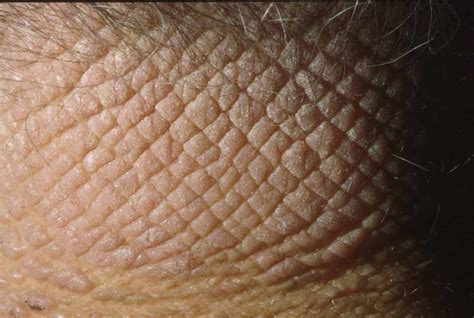 Lichen Simplex Chronicus Neurodermatitis Prurigo Dermatology Advisor