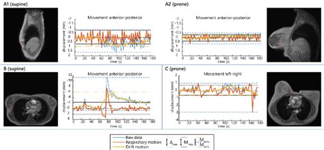 Example Of Motion Traces In Three Different Patients A Sagittal Cines