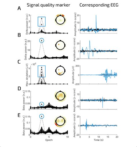 Example Artifacts Detected During The Artifact Rejection Routine A Download Scientific