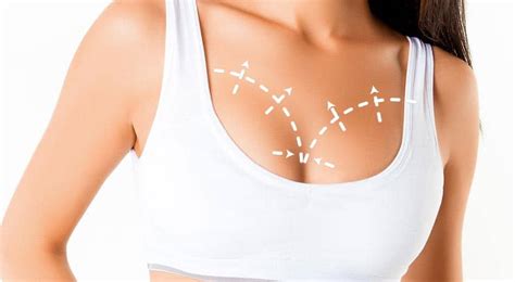 Prp Juvederm® Breastlift And Breast Enhancement Peoria Az