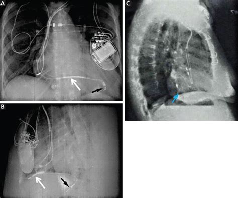 Biventricular Pacemaker Chest X Ray Cardiac Resynchronization Therapy