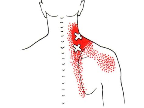 Levator Scapula Trigger Point Map Health Myofascial