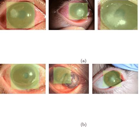 Automated Eye Disease Classification Method From Anterior Eye Image