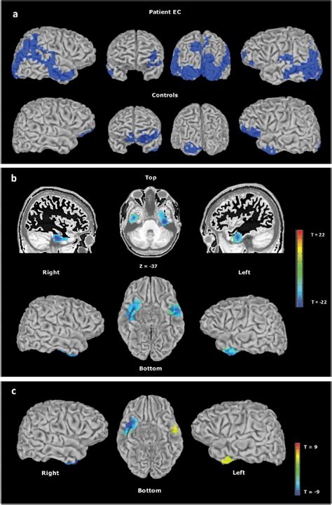 A Patterns Of Mean Functional Activation For Ec And The Control Group