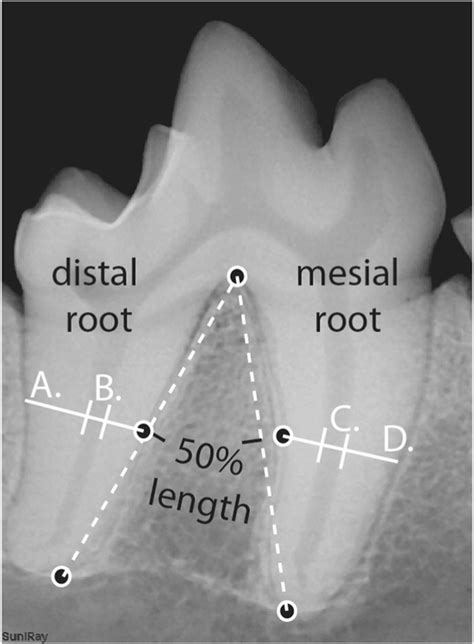 Guide To The Measurements Taken On The Mandibular M1 A Width Of The